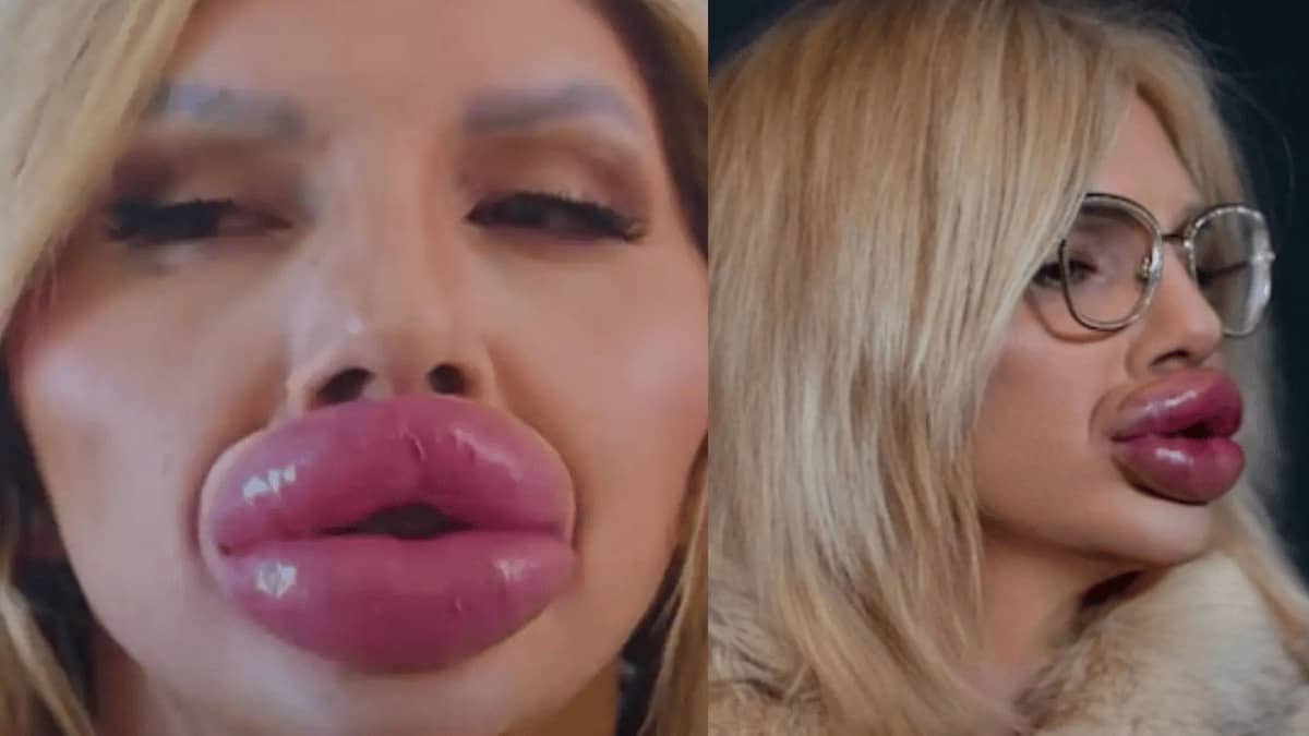 ‘Viral Lip Queen’: Spanish Influencer Spends Rs 39 Lakhs for World’s ...