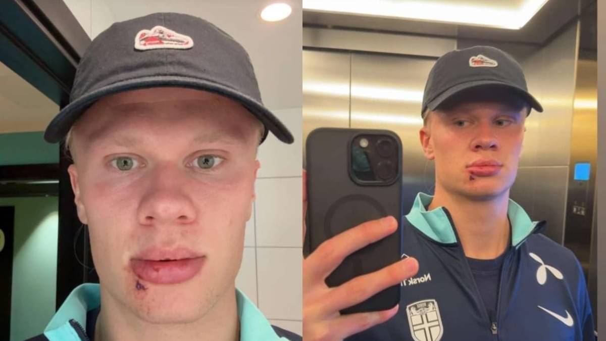 Manchester City Star Erling Haaland Suffers Freak Injury On International Duty, Needs Three ...