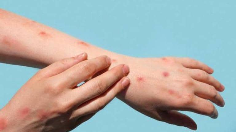 Expert says 'Monkeypox like any other sexually transmitted disease ...