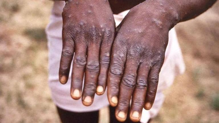 Monkeypox: UAE reports its first case; says 'completely prepared' to ...