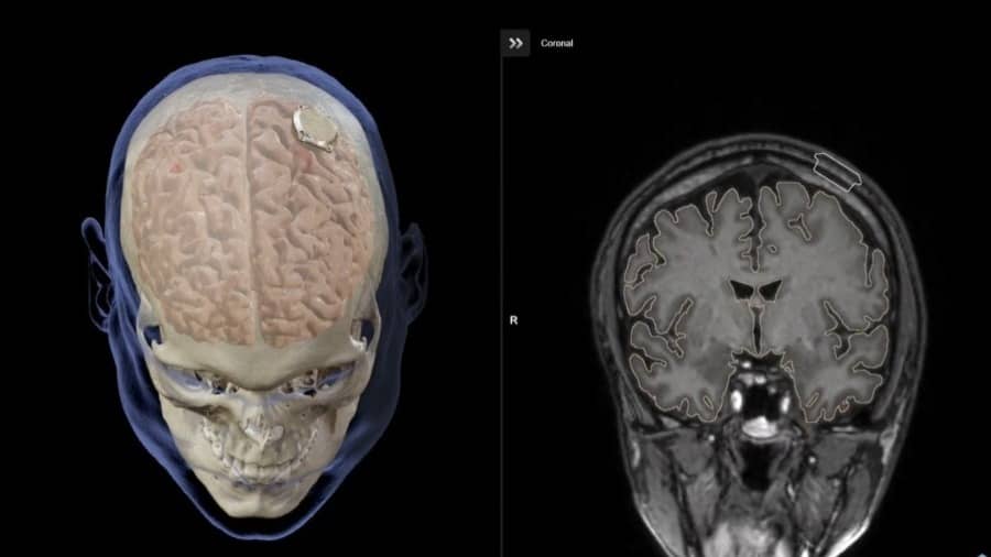 Man With Paralysis Uses Mind To Control Devices: Elon Musk's Neuralink ...